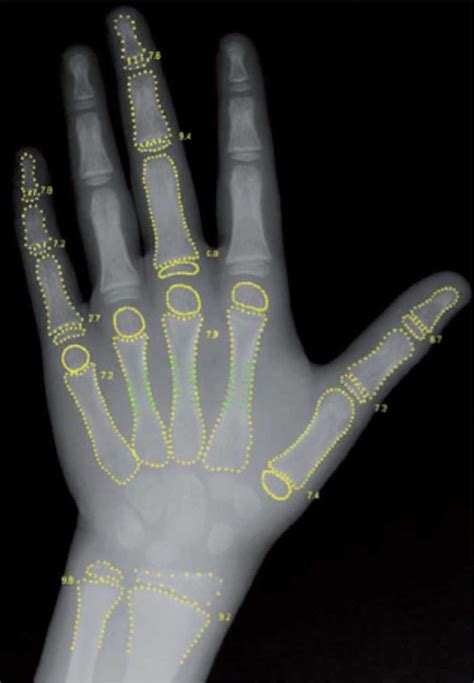 Medical Dentix Por qué es importante la radiografía carpal en la