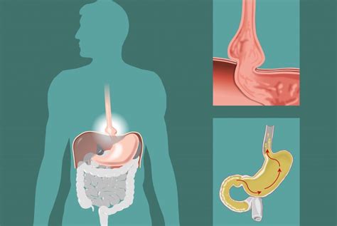 Qué puedo comer si tengo una hernia de hiato Ángel Troncoso