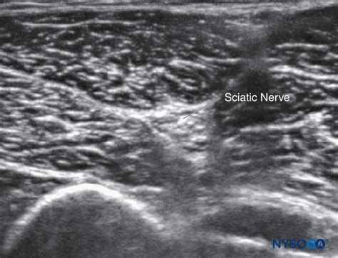 Ultrasound Guided Genitofemoral Nerve Block Agaclip
