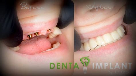 Pret Implant Dentar Cat Costa Un Implant Dentaimplant