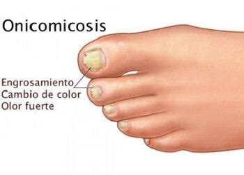 Onicomicosis Cuando Los Hongos Est N En Las U As Mejor Con Salud