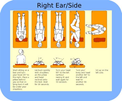 Epley Manoeuvre Diagram Epley Maneuver Vertigo Bppv Rosh Man