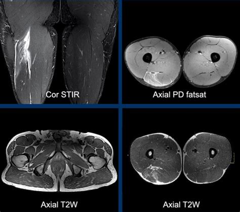 The Radiology Assistant Hamstring Injury