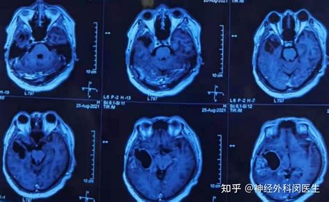 胶质母细胞瘤的二次手术 知乎