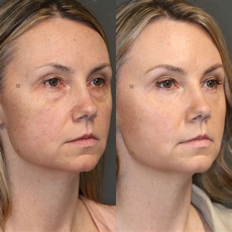 Details 78 Surgery Under Eye Bags Latest In Cdgdbentre