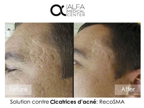Traitement cicatrice Avant et après Multiesthetique fr