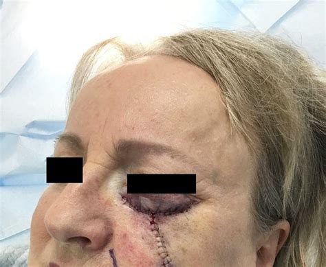 BCC Left Lower Eyelid Dr Vindy Ghura Dermatologist Manchester