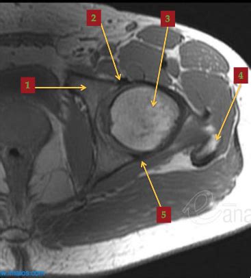 MRI Axial Hip Diagram Quizlet