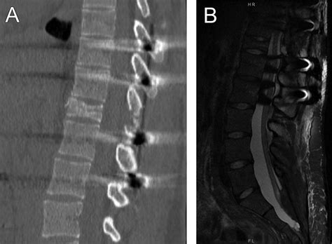 Mini Open Spinal Column Shortening For The Treatment Of Adult Tethered