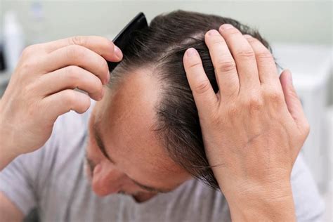 What Is Seborrheic Dermatitis Capilclinic