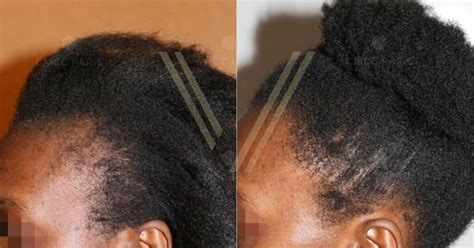 Greffe De Cheveux Afro En Turquie Tarifs Mis Jour