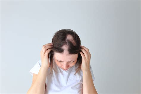 Como Tratar A Alopecia Condi O Que Atinge As Cantoras Maiara E