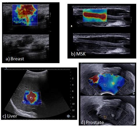 Ultrafast Ultrasound Imaging IntechOpen