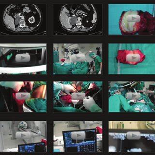IORT Simulation Unresectable Pancreatic Adenocarcinoma With RADIANCE