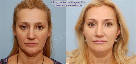 Lifting du visage Cou Facelift Necklift Avant Après Photos