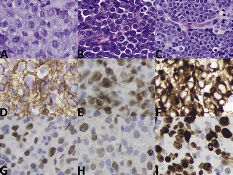 High Grade B Cell Lymphoma A Term Re Purposed In The Revised WHO