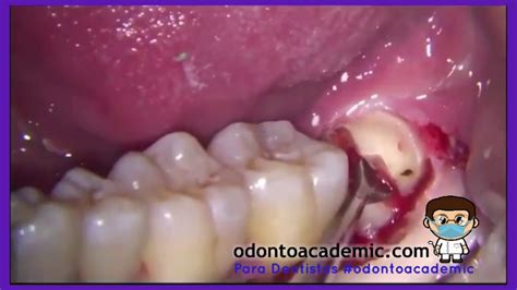 Cirugía Bucal 3er Molar Inferior Odontosección ODONTOACADEMIC