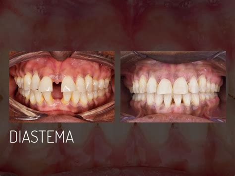 Diastema Biprotrusión Ortodoncia Madrid