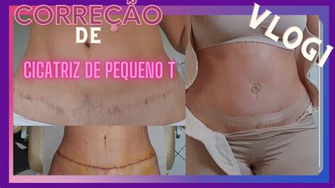 Reparo Correção de cicatriz de abdominoplastia pequeno T vlog 1º Parte