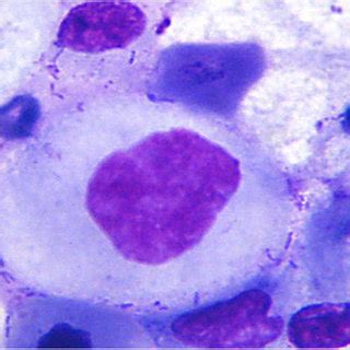 Cytological Examination Of Material Cervix HPV Induced CIN III A