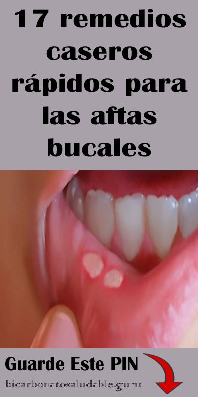 Remedios Caseros R Pidos Para Las Aftas Bucales Salud Aftas