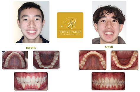 Before And Afters Perfect Smiles Orthodontics