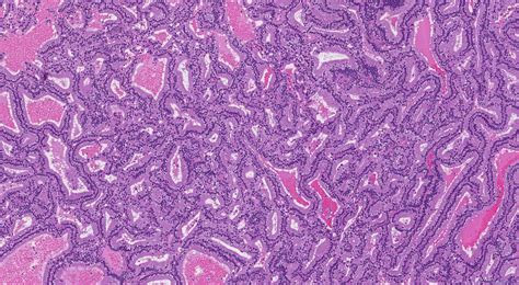 Parathyroid Hyperplasia Atlas Of Pathology