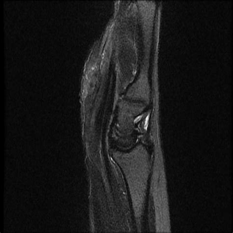 Carpal Tunnel Syndrome And De Quervain Tenosynovitis Image