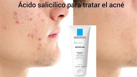 ÁCIDO SALICÍLICO PARA EL ACNÉ COMO USARLO los cuidados que debes de