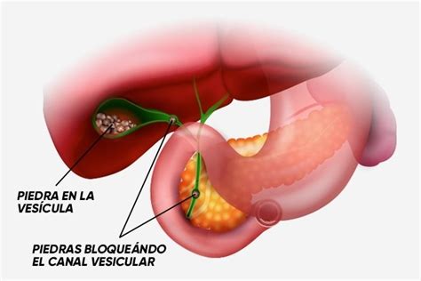 6 Síntomas que pueden indicar piedras en la vesícula Cálculos biliares