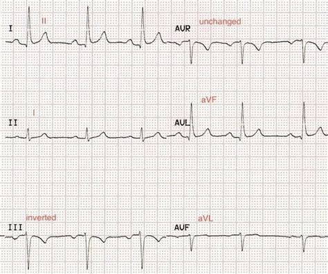 View Of Common ECG Lead Placement Part I Limb Lead 40 OFF