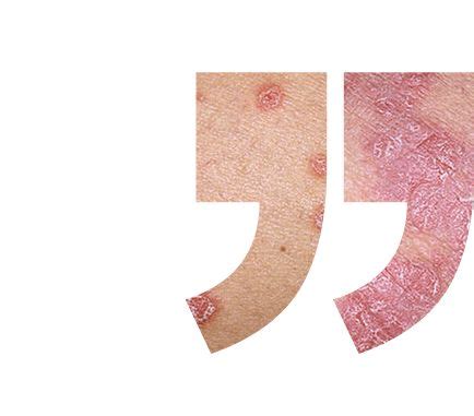 Fito Romatizma Clinic Romatizmal Hastalıklar Scleroderma