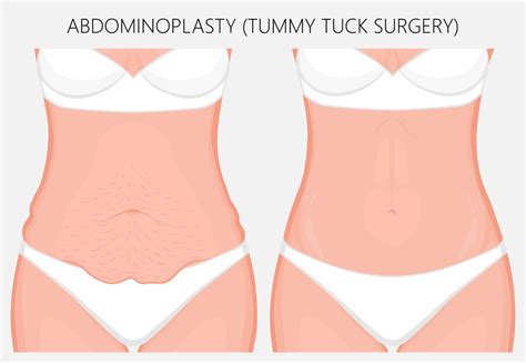 Cuidados para una cicatriz de Abdominoplastia Dr Joaquin Muñoz