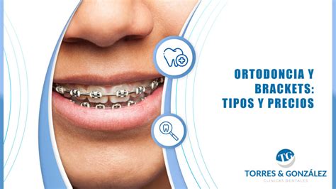 Costo de ponerse brackets en España precio y opciones disponibles 2024