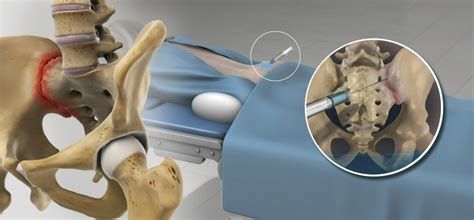 Sacroiliac Joint Dysfunction Treatment In Fairfax Va And Potomac Md
