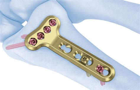 Variable Angle LCP Two Column Volar Distal Radius Synthes 43 OFF