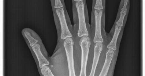 RADIOGRAFÍA CARPAL MEDICAL DENTIX S A C