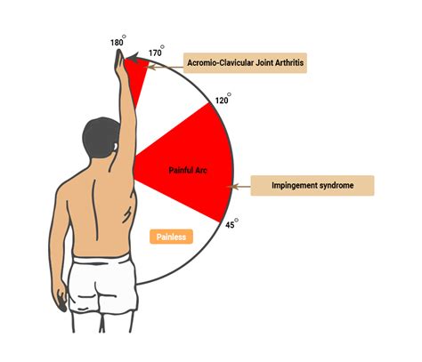 Prueba del Arco Doloroso de hombro Painful Arc Explicación completa