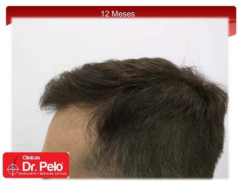 Injerto Capilar Para Aumento Densidad En La Zona Frontal Con