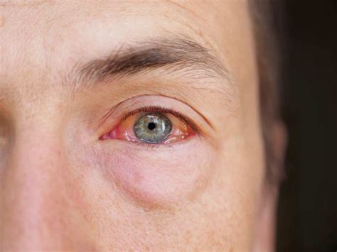 Bindehautentzündung Wien Symptome Ursachen Therapie
