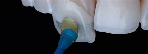 LES FACETTES Biodental Tournai