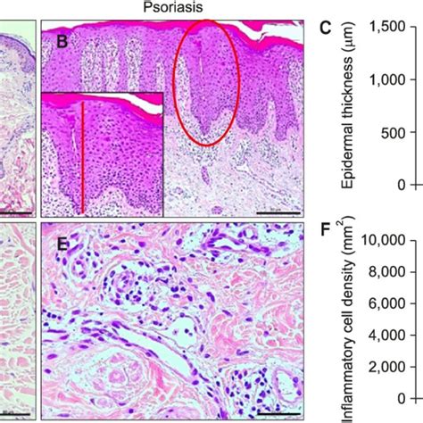 Epidermal Thickness And Inflammatory Cell Density Of Psoriasis And