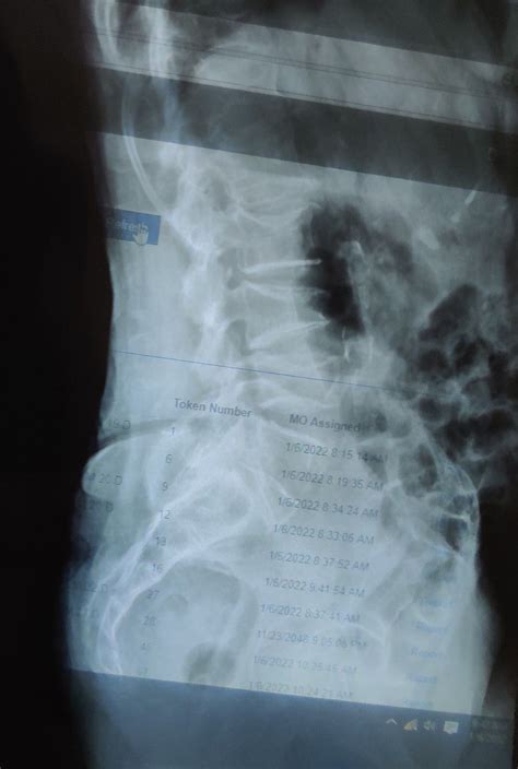 Osteoporotic Vertebral Compression Fracture MEDizzy