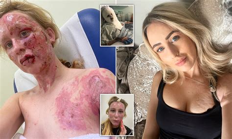 Rd Degree Burns Healed
