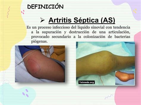 Artritis Septica semiología clinica pptx Descarga Gratuita