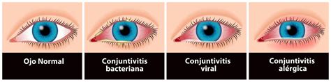 Tipos y causas de la conjuntivitis bacteriana viral y alérgica