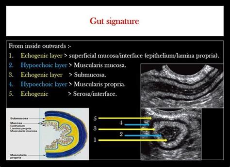 Abdomen Pathology Gi Tract Flashcards Quizlet