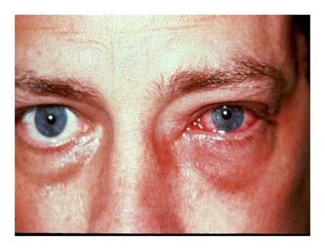Conjuntivitis Viral