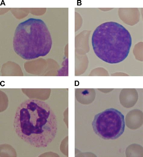 acute lymphoblastic leukemia detection and classification of its subtypes using pretrained deep