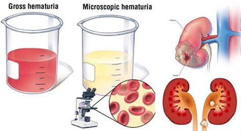 Microhematuria Definition Causes Symptoms Diagnosis Treatment